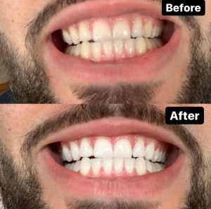 Take-Home Teeth Whitening Westminster Colorado | Whiten Teeth At Home