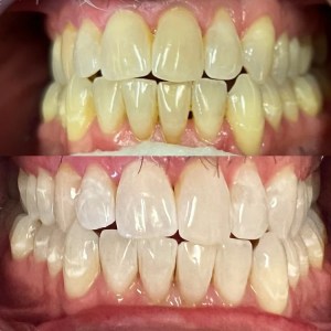 In-Office Teeth Whitening Westminster | Professional Teeth Whitening