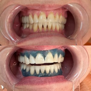 In-Office Teeth Whitening Westminster | Professional Teeth Whitening