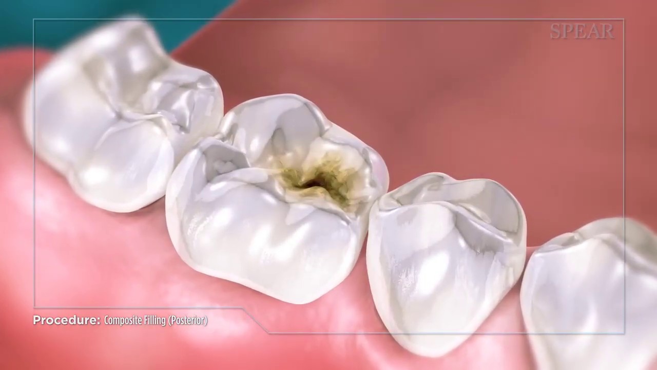 Composite Tooth Fillings Westminster | White Composite Dental Fillings